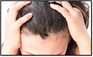 Dandruff or Nits: How Can You Tell?